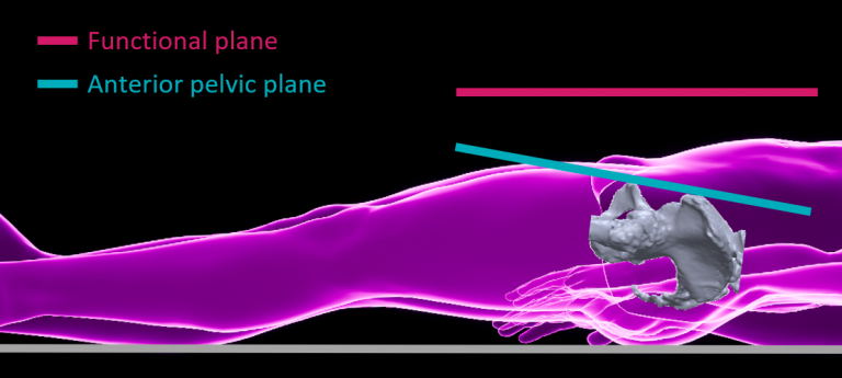 Measuring the Placement of the Acetabular Component – Navbit