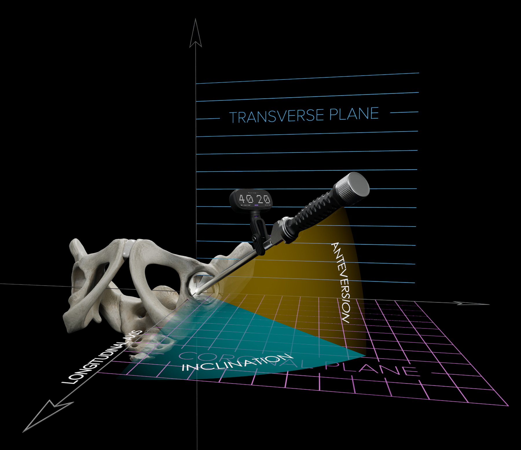 Measuring The Placement Of The Acetabular Component Navbit