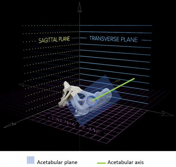 Measuring the Placement of the Acetabular Component – Navbit